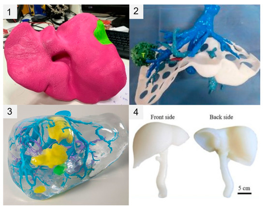 Three-Dimensional Printed Liver Models for Surgical Planning and ...