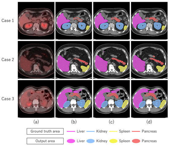 Hybrid Multiple-Organ Segmentation Method Using Multiple U-Nets in PET ...