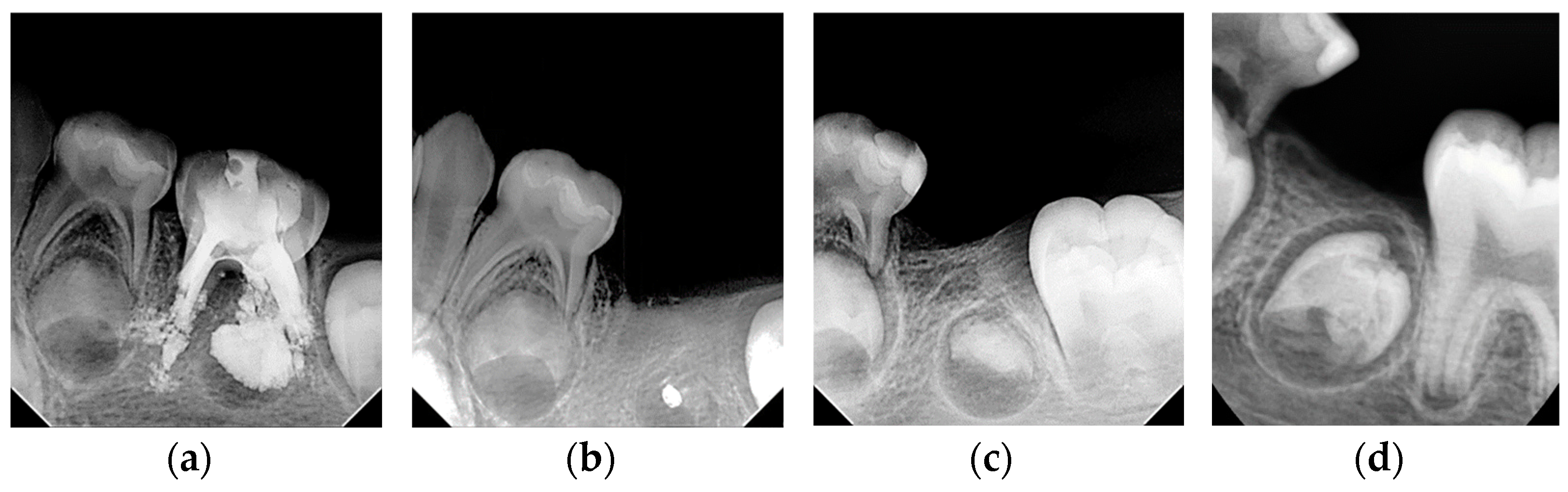 Iatrogenic Incidents in Primary Molar Pulpectomy: A Case Series Report ...