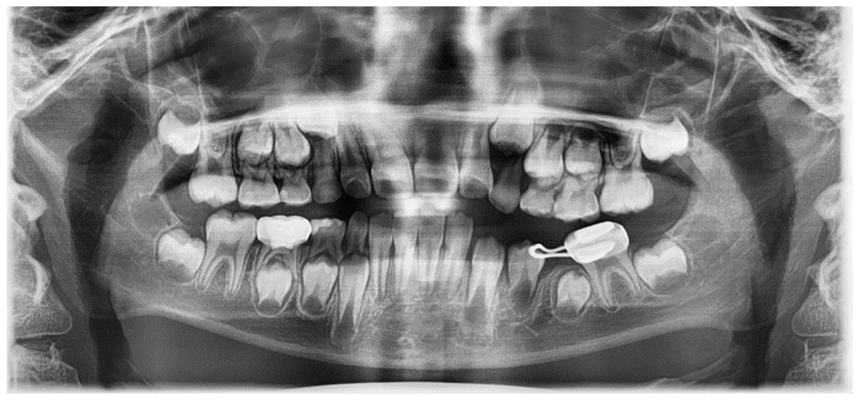 Iatrogenic Incidents in Primary Molar Pulpectomy: A Case Series Report ...