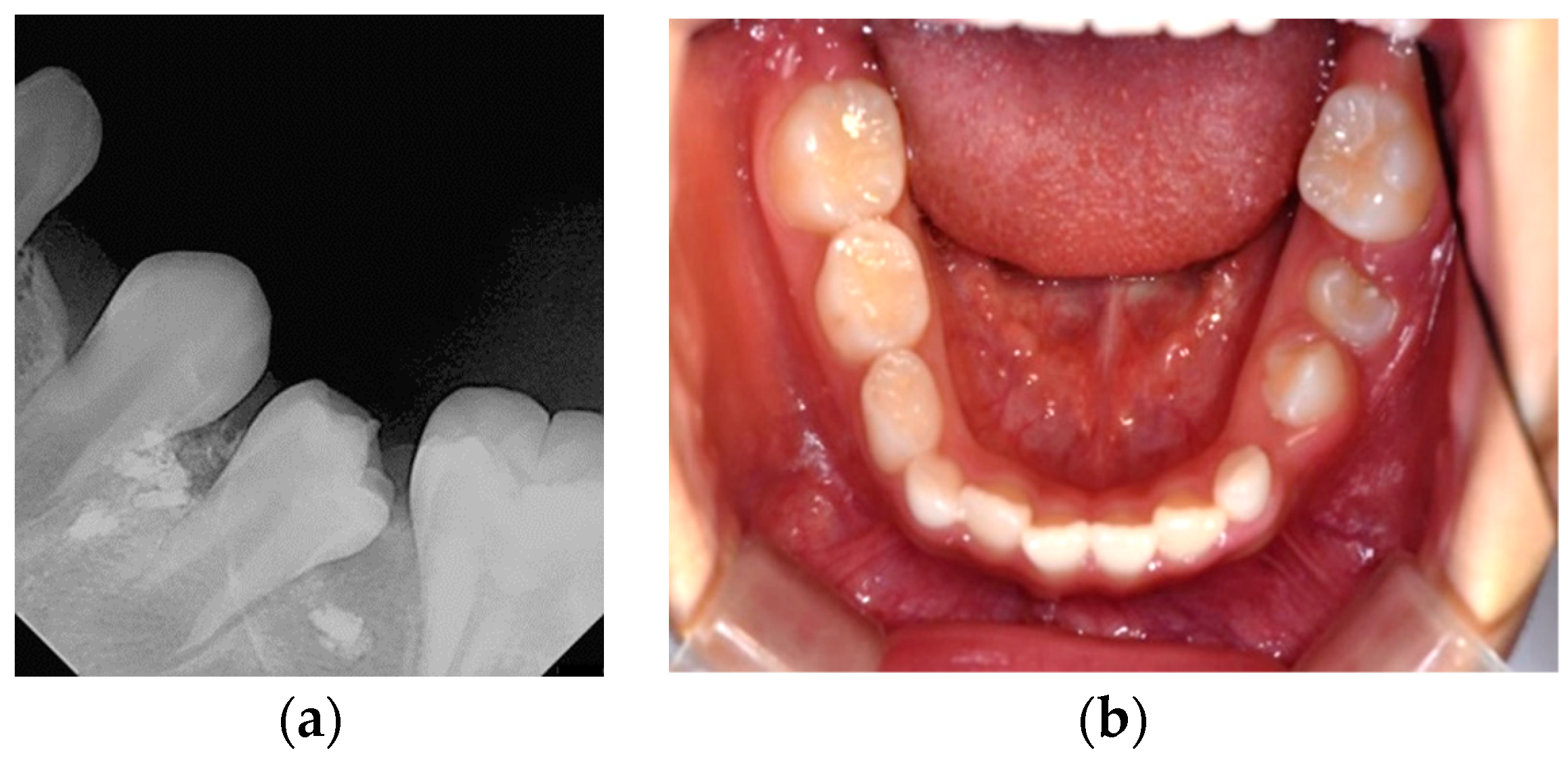 Iatrogenic Incidents in Primary Molar Pulpectomy: A Case Series Report ...