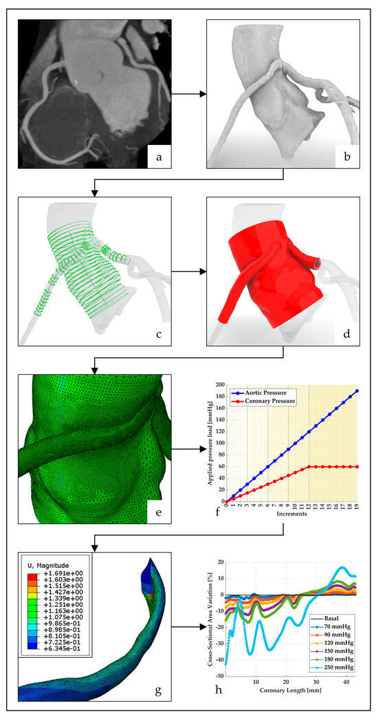 Assessment of Intramural Segment Compression in Anomalous Coronary Arteries through Patient ...