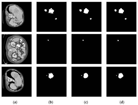 Liver Tumor Computed Tomography Image Segmentation Based on an Improved ...