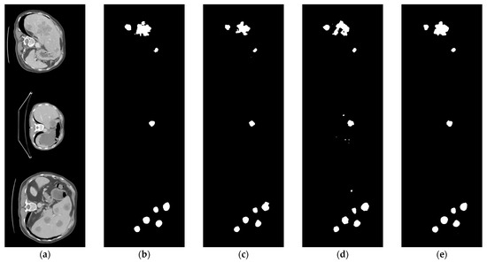 Liver Tumor Computed Tomography Image Segmentation Based on an Improved ...