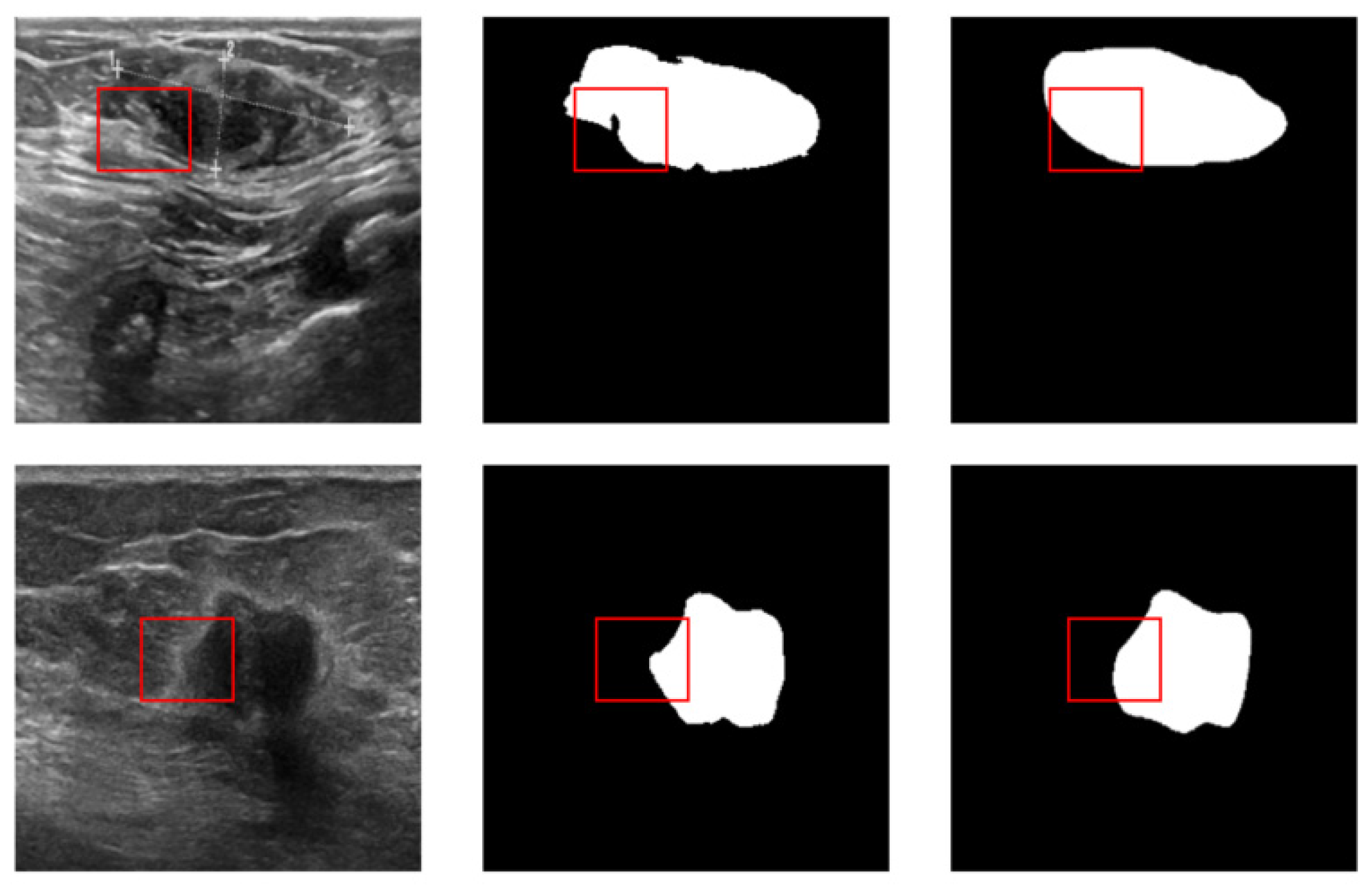 Rmau Net Breast Tumor Segmentation Network Based On Residual Depthwise Separable Convolution