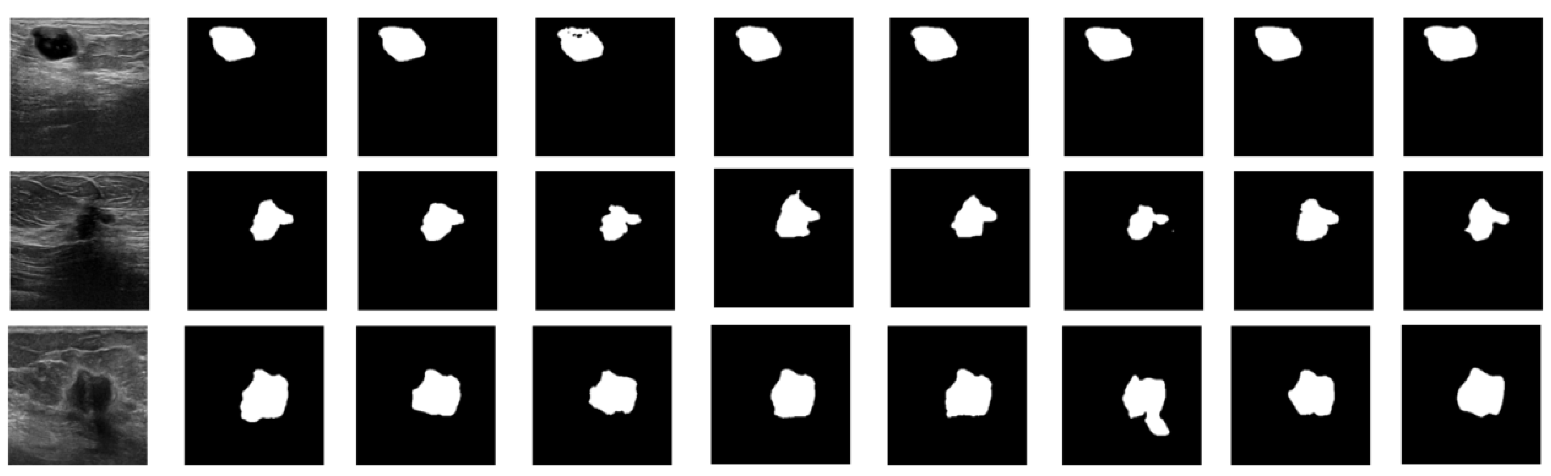 Rmau Net Breast Tumor Segmentation Network Based On Residual Depthwise Separable Convolution