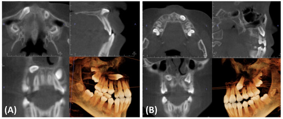 Nonextraction Orthodontic Treatment of Severely Impacted Maxillary ...