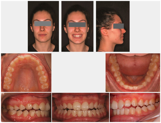Open Bite Treatment with Combined Aligners and Myofunctional Appliances ...