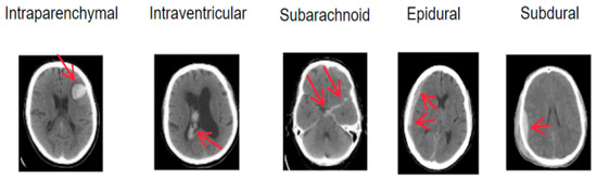 MSRL-Net: An Automatic Segmentation of Intracranial Hemorrhage for CT ...