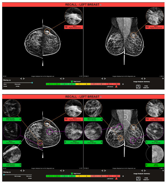 Application of Artificial Intelligence in the Mammographic Detection of ...