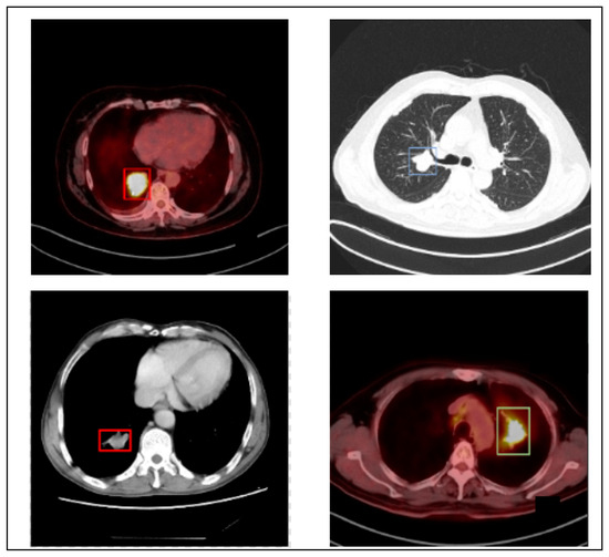Lung Cancer Detection Model Using Deep Learning Technique