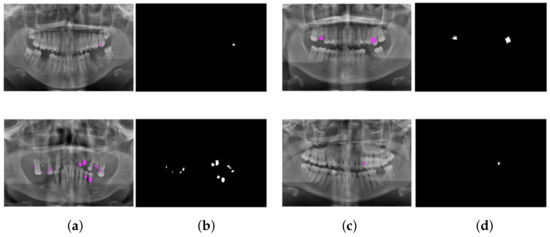 Detection of Cavities from Dental Panoramic X-ray Images Using Nested U-Net Models