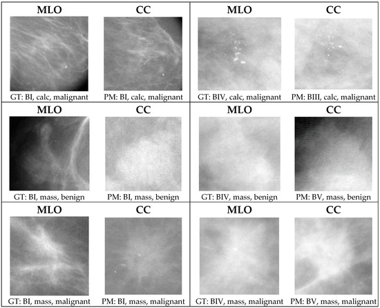 Comprehensive Analysis of Mammography Images Using Multi-Branch ...