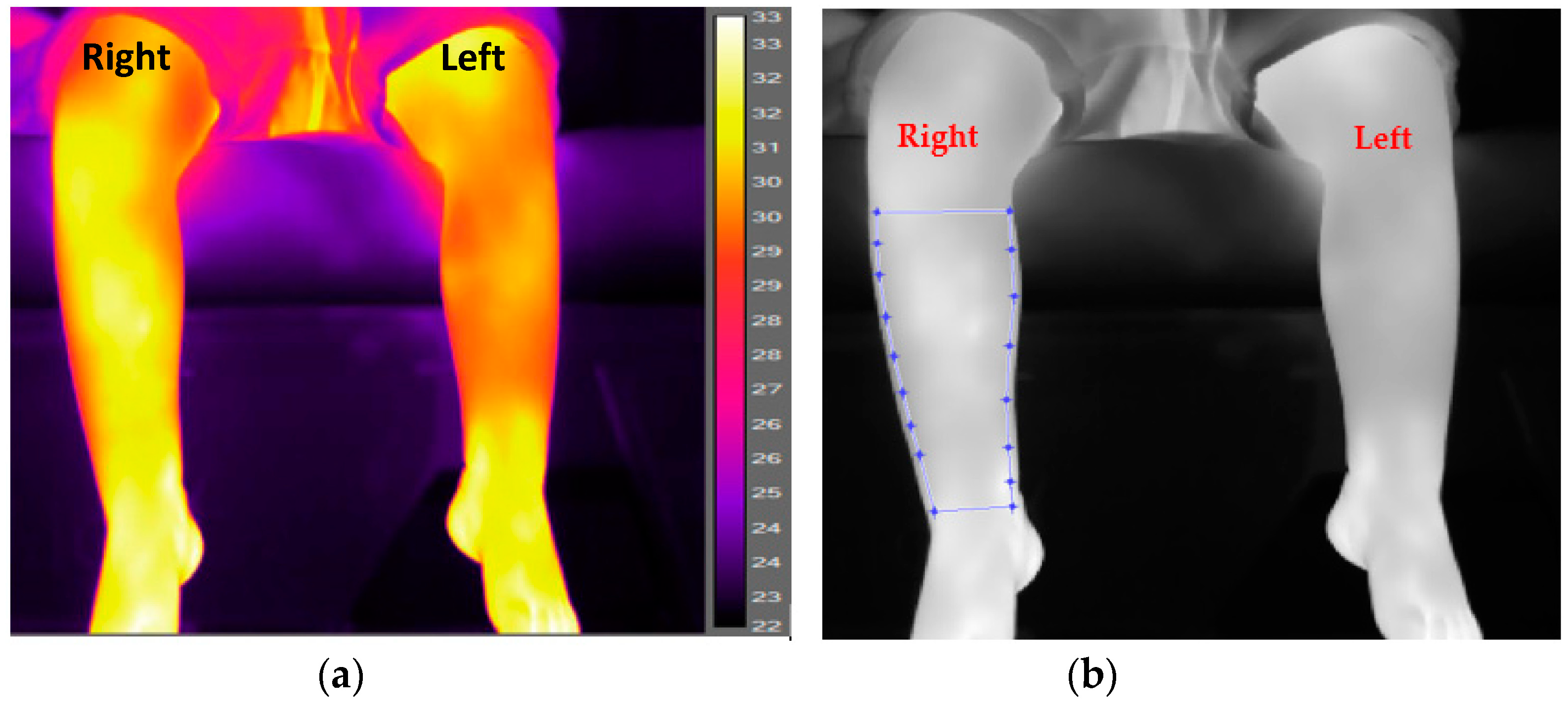 Infrared Thermal Imaging Analysis in Screening for Toddler’s Fracture: A Proof-of-Concept Study
