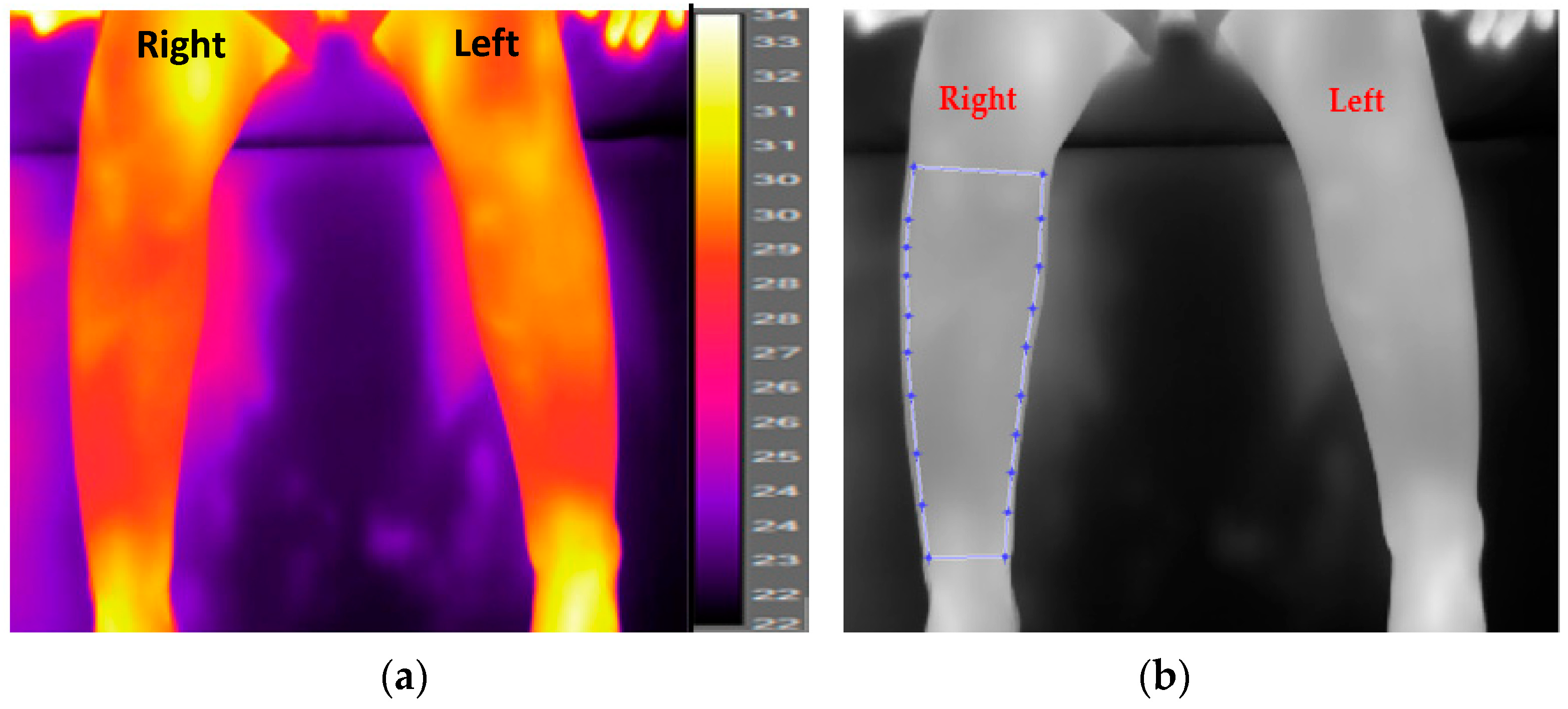 Infrared Thermal Imaging Analysis in Screening for Toddler’s Fracture: A Proof-of-Concept Study