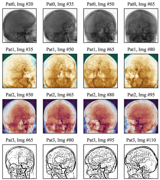 Automatic Approach for Brain Aneurysm Detection Using Convolutional Neural Networks