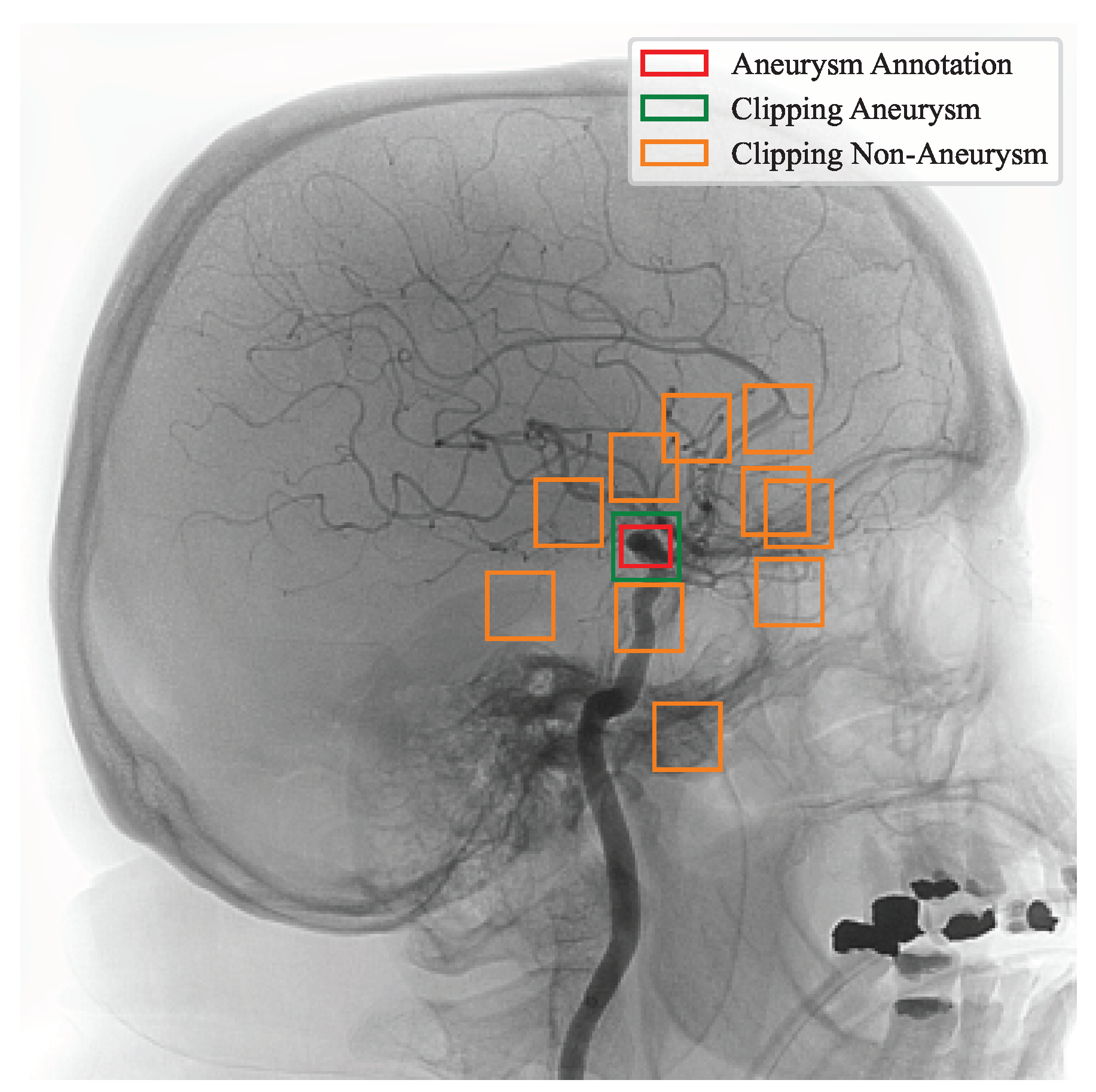 Automatic Approach for Brain Aneurysm Detection Using Convolutional Neural Networks