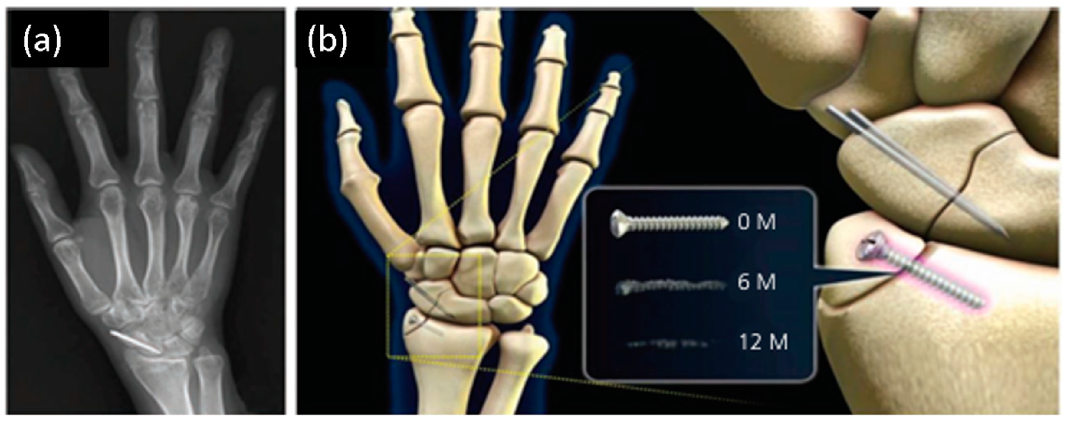 Biodegradable Magnesium Alloys for Biomedical Implants: Properties ...