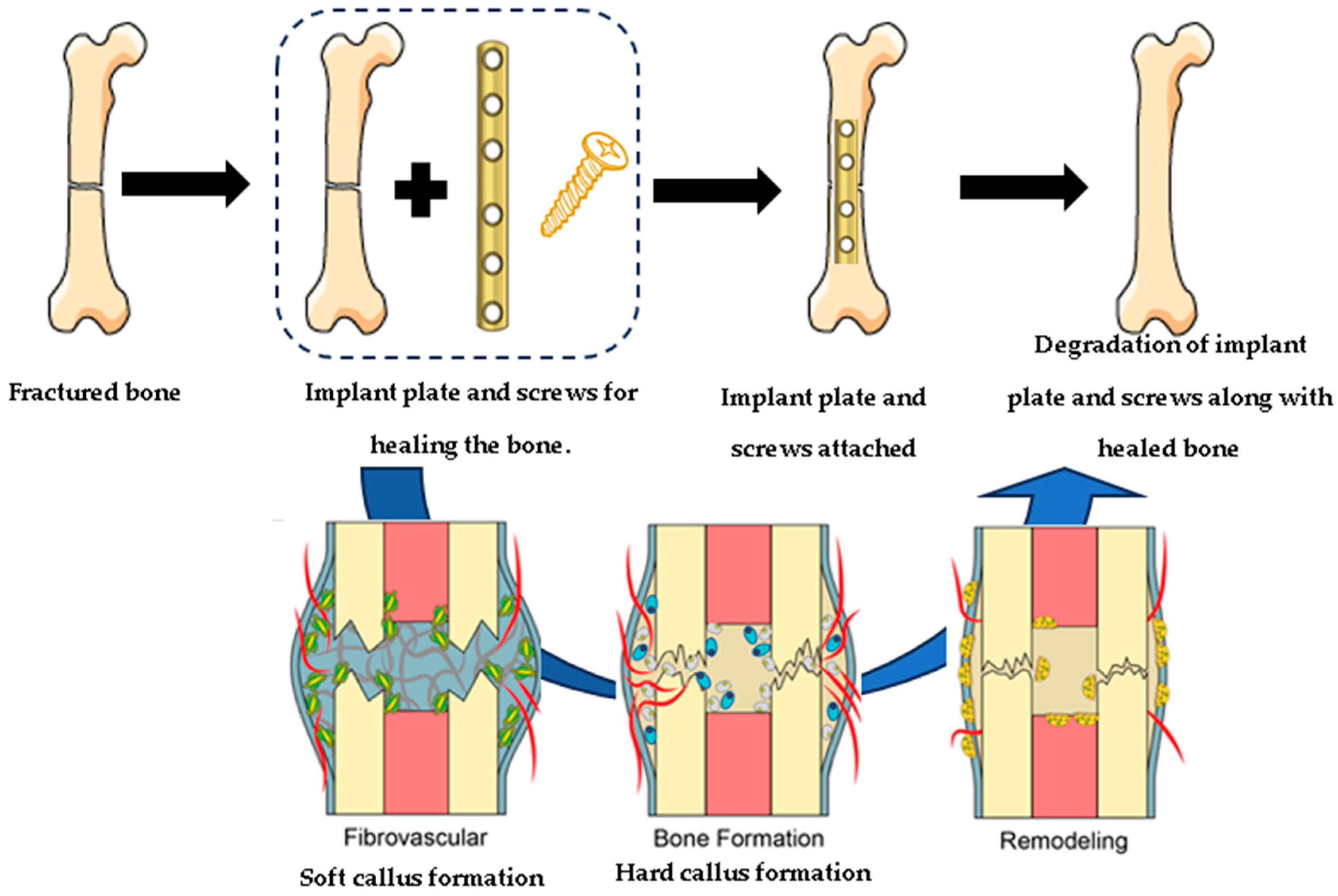 Biodegradable Magnesium Alloys for Biomedical Implants: Properties ...