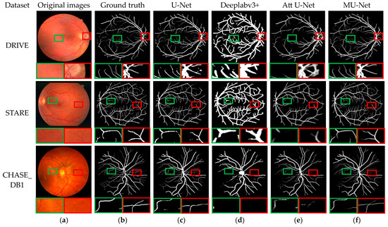 Research on Retinal Vessel Segmentation Algorithm Based on a Modified U-Shaped Network