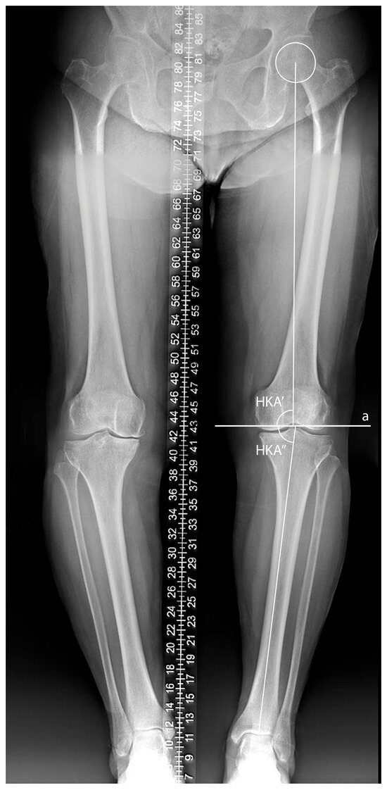 The Validity and Absolute Reliability of Lower Extremity Angle Values on Full-Leg Standing ...