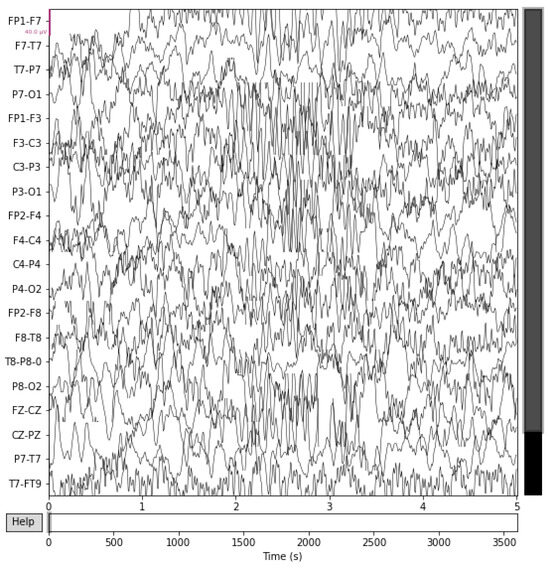 Epileptic Seizure Classification Based On Random Neural Networks Using Discrete Wavelet