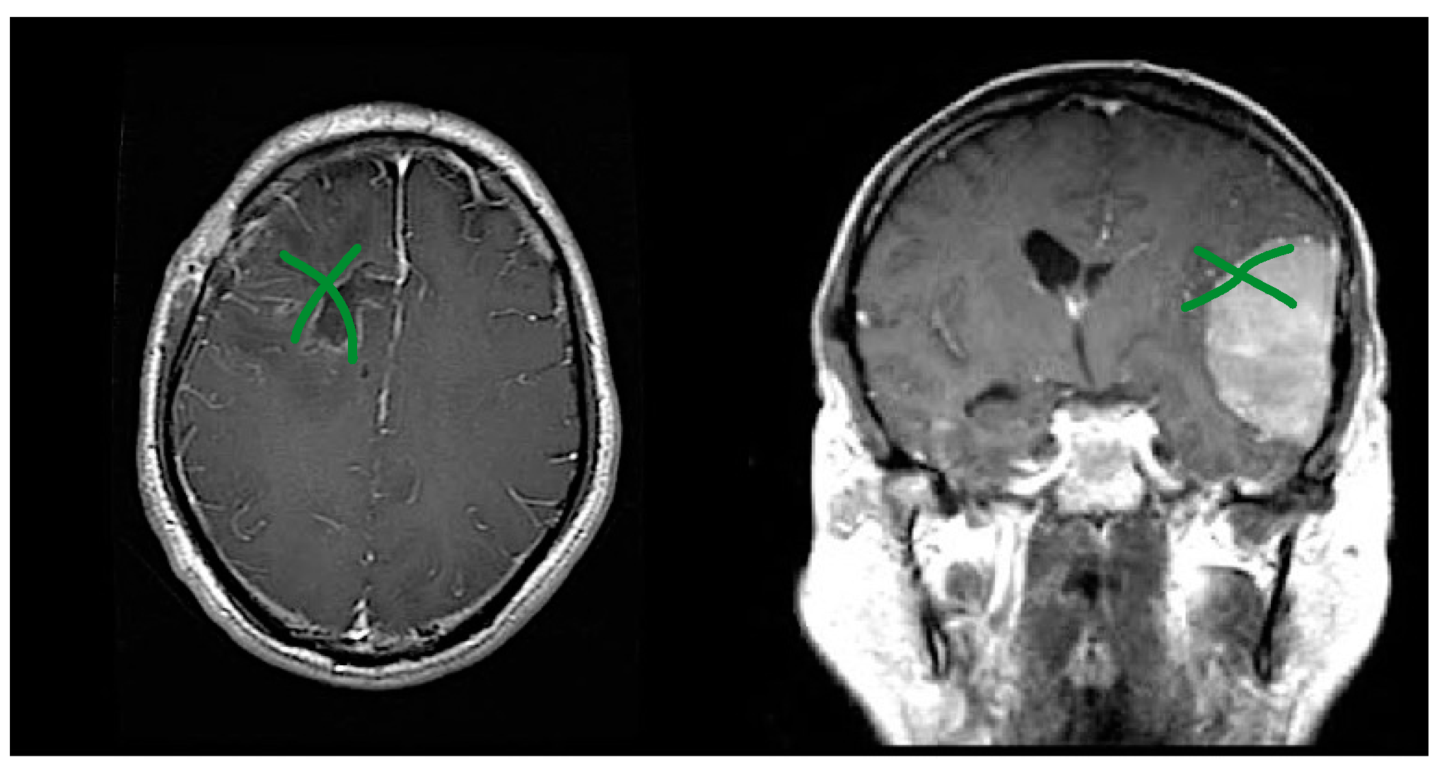 Applied Sciences | Free Full-Text | Brain Tumor Detection with Deep Learning Methods’ Classifier ...