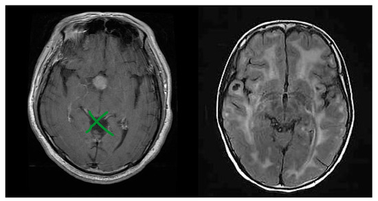 Brain Tumor Detection with Deep Learning Methods’ Classifier ...