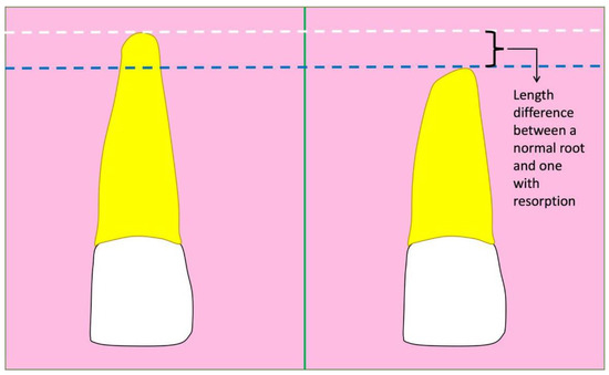 Root Resorption during Orthodontic Treatment with Clear Aligners vs ...