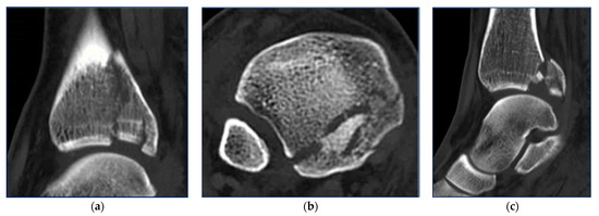 Fixation of Posterior Malleolus in Trimalleolar Ankle Fractures ...