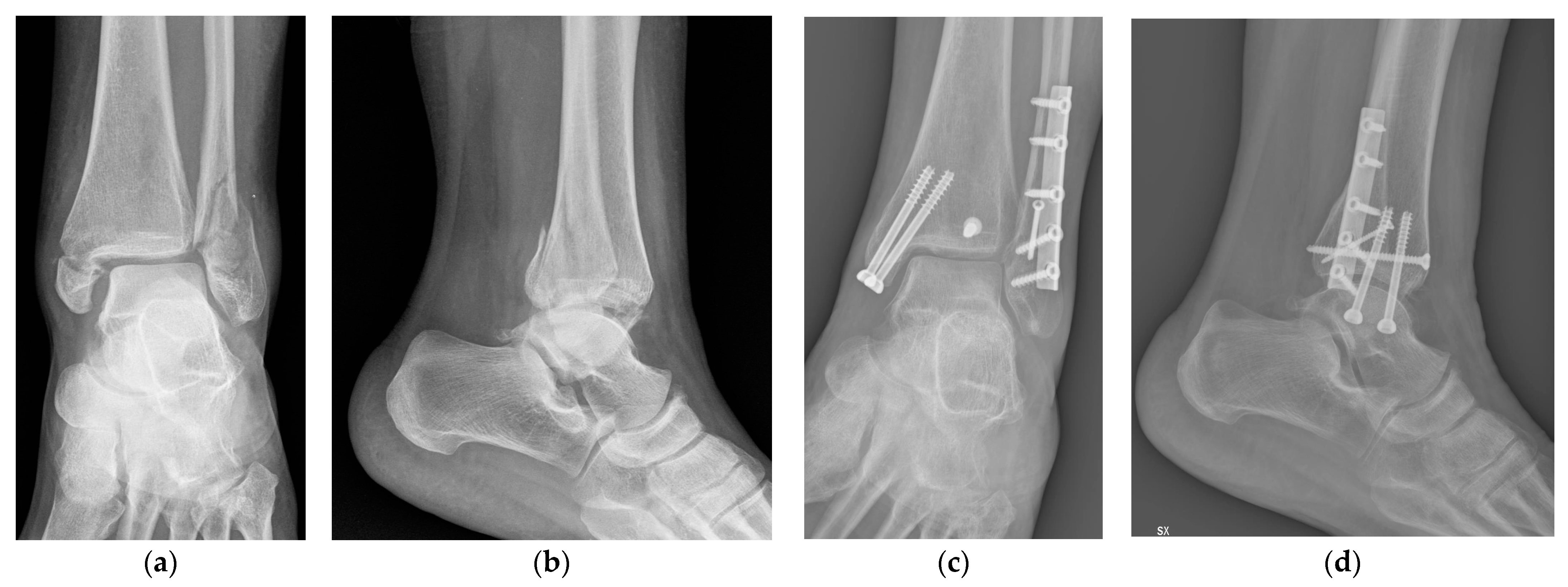 Applied Sciences Free Full Text Fixation Of Posterior Malleolus In