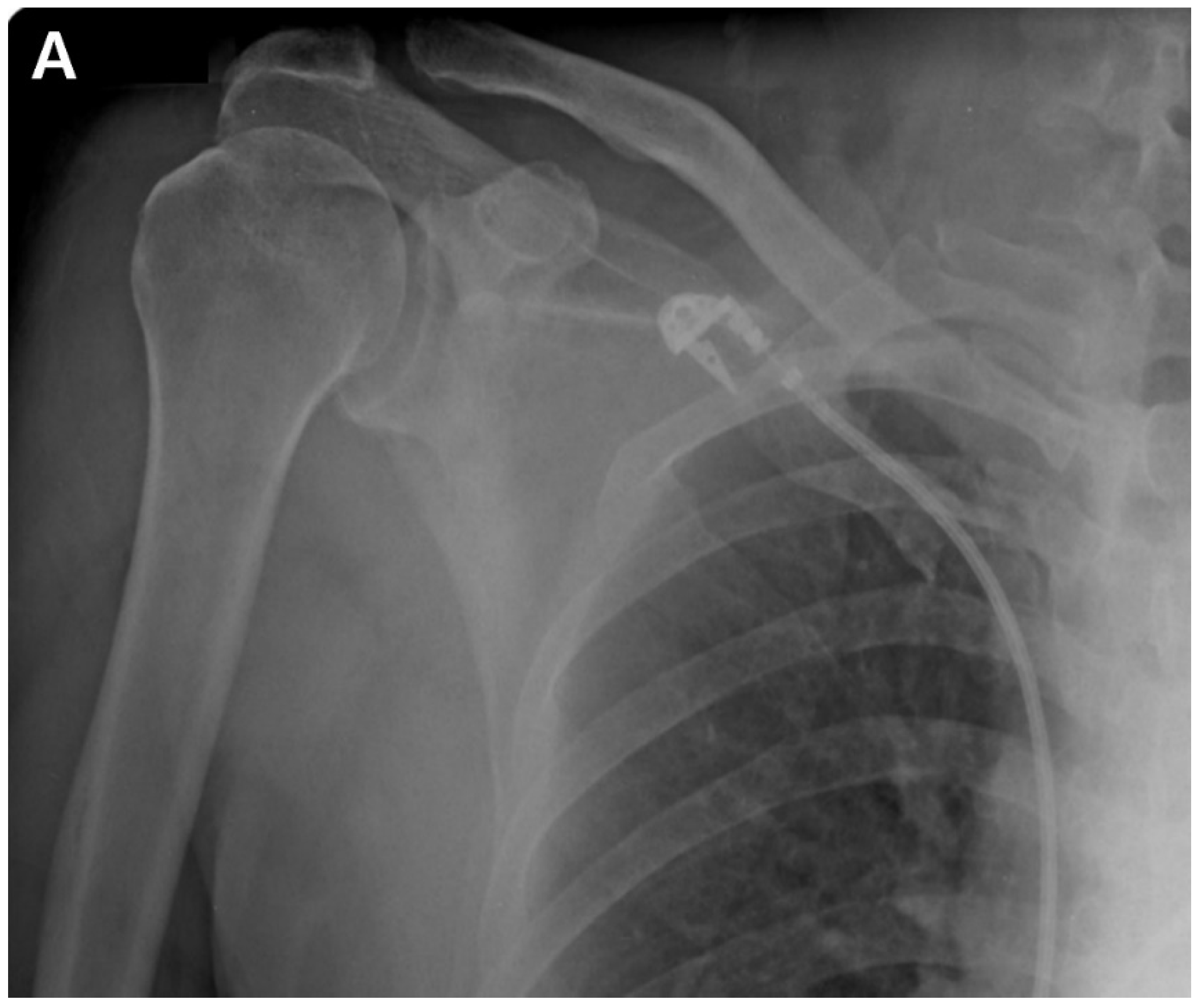 Osteonecrosis of Humeral Head after Arthroscopic Capsular Release for ...