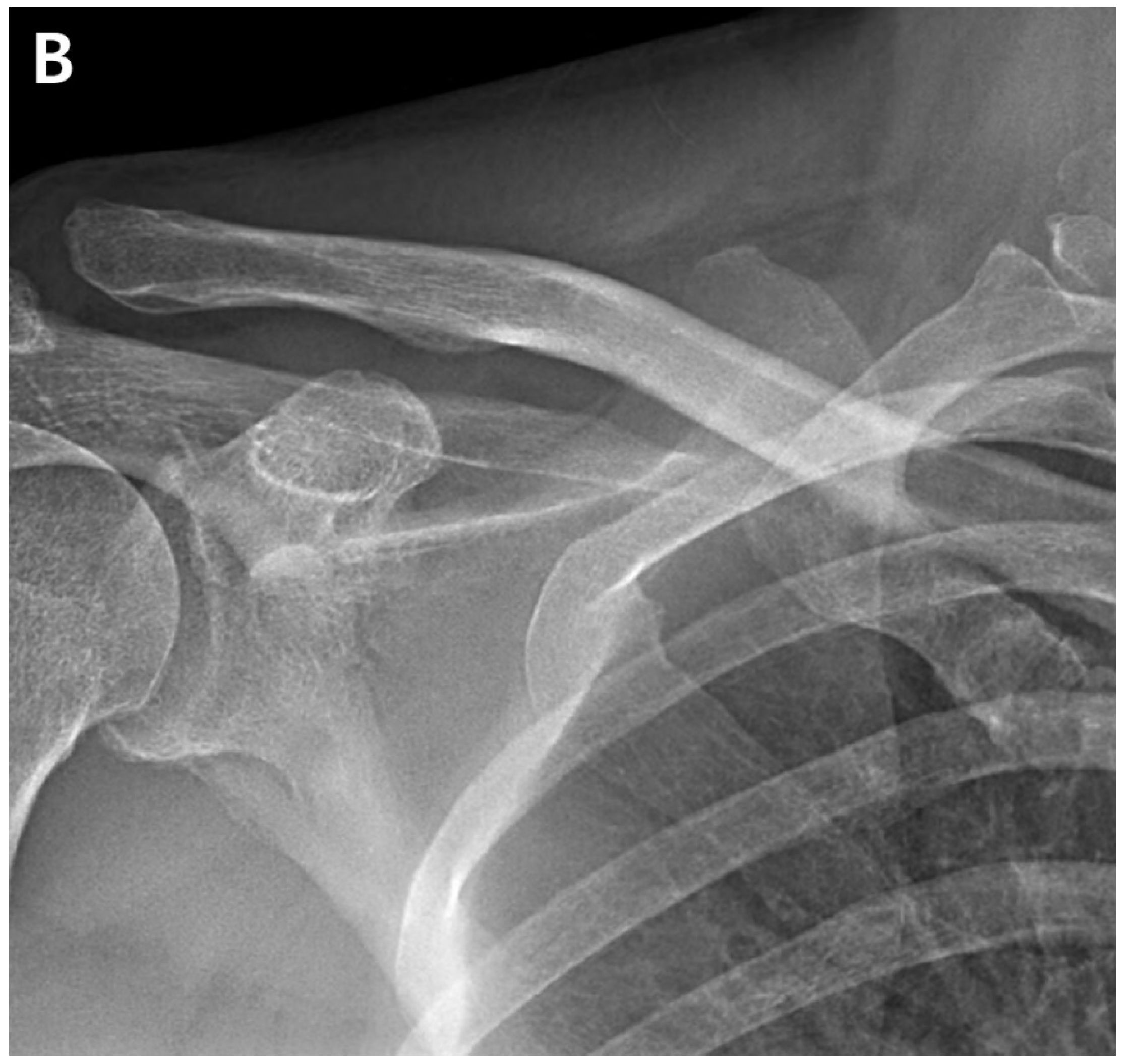 Osteonecrosis of Humeral Head after Arthroscopic Capsular Release for ...