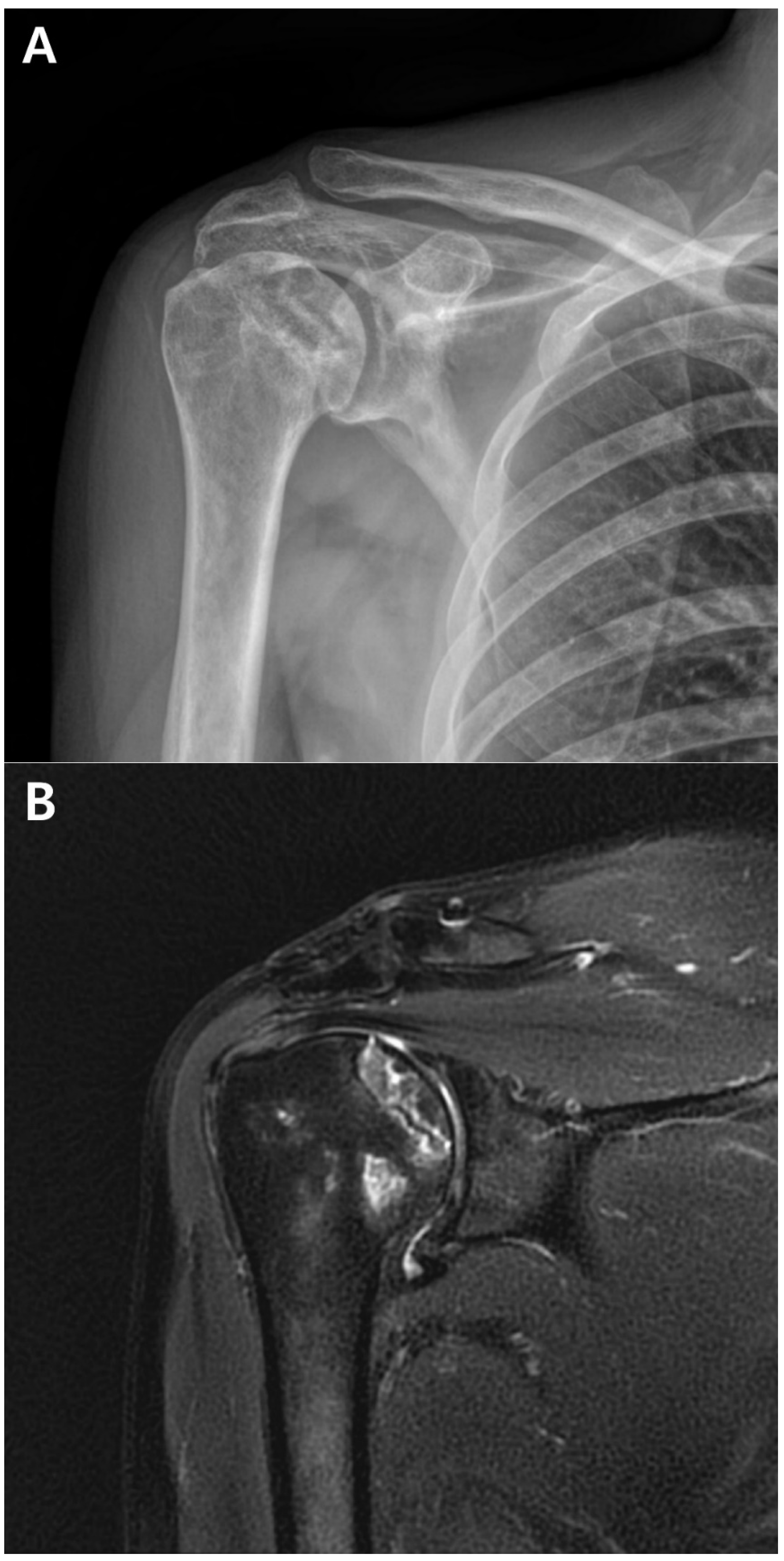 Osteonecrosis of Humeral Head after Arthroscopic Capsular Release for ...