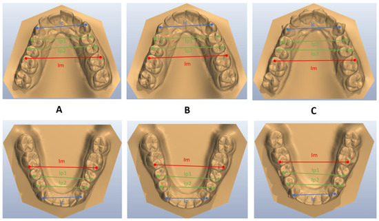Evaluation of Tooth Movement Accuracy with the F22 Aligner System: A ...