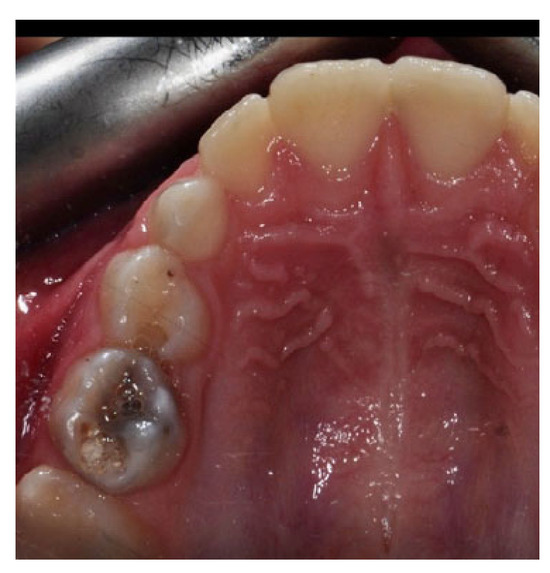 Caries in Primary Molars: Is Silver Diamine Fluoride Effective in ...