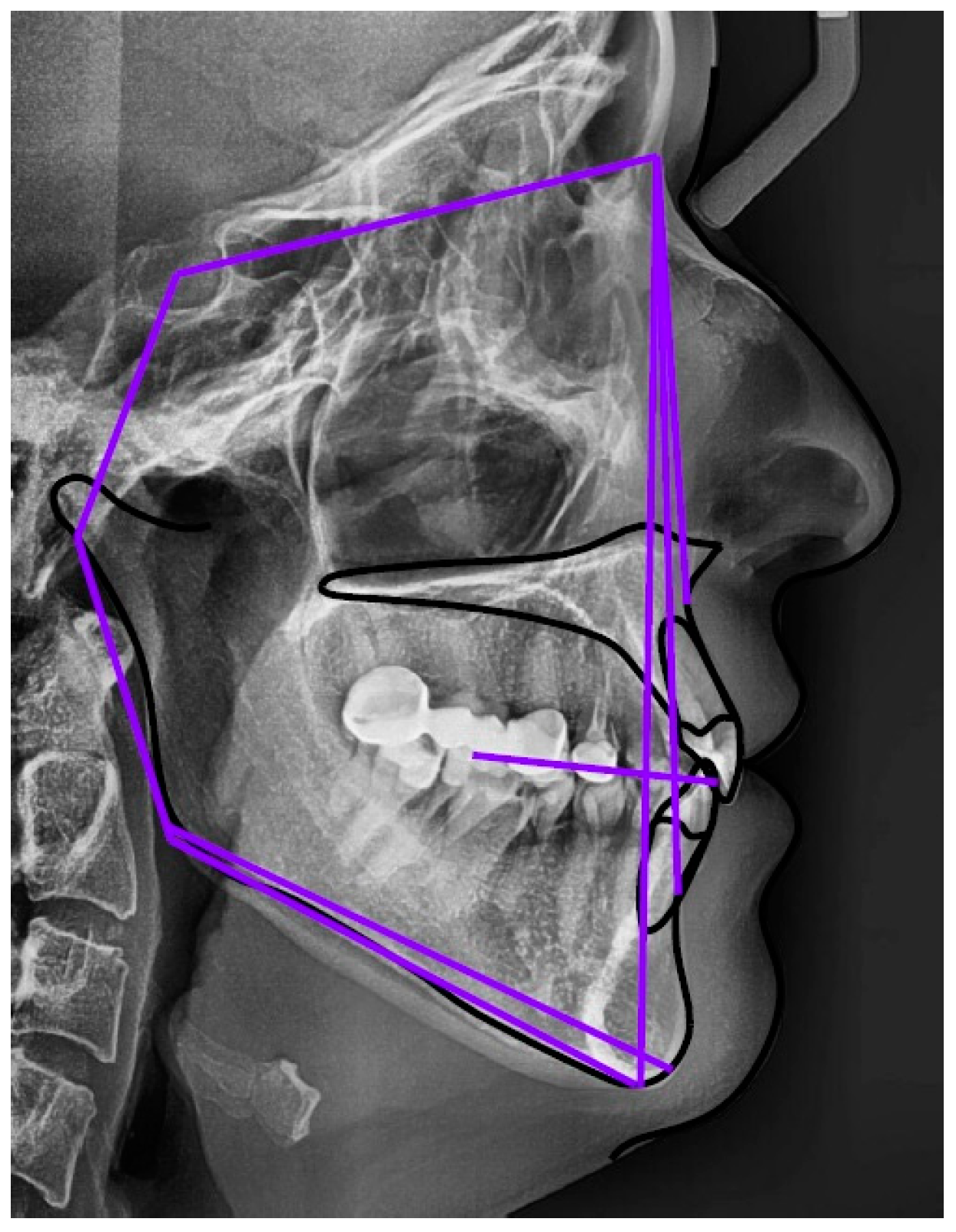 Radiological Measurement of Sella Turcica Dimensions in Different ...