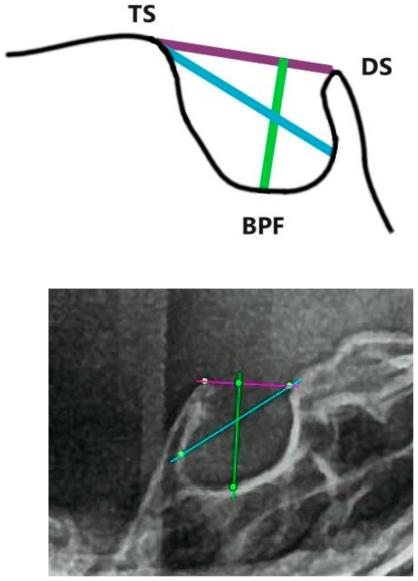 Radiological Measurement of Sella Turcica Dimensions in Different ...