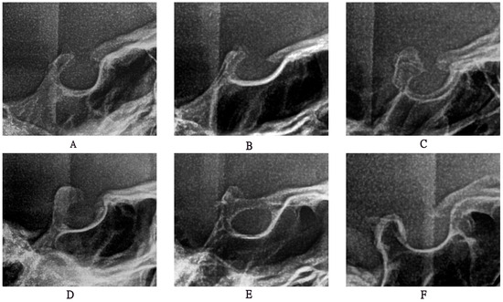 Radiological Measurement of Sella Turcica Dimensions in Different ...