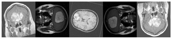 Automated Brain Tumor Identification in Biomedical Radiology Images: A ...