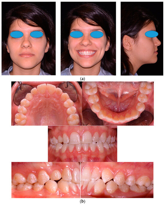 Biomechanical Effects of Different Auxiliary–Aligner Designs on the ...