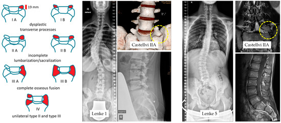 Lumbosacral Transitional Disorder as a Missing Link in Symptomatic ...