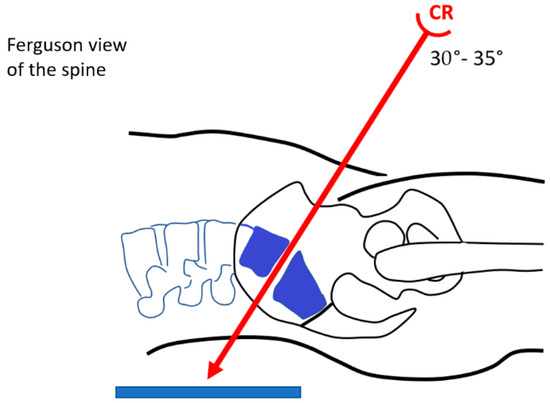 Lumbosacral Transitional Disorder as a Missing Link in Symptomatic ...