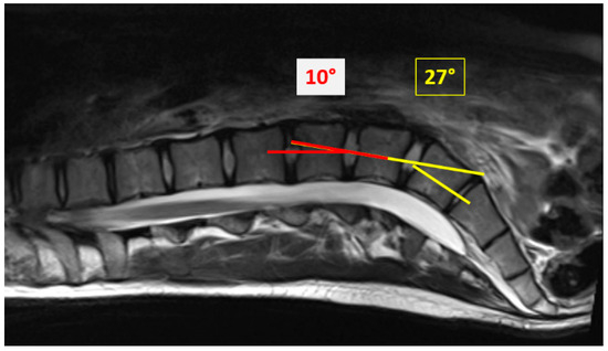 Lumbosacral Transitional Disorder as a Missing Link in Symptomatic ...