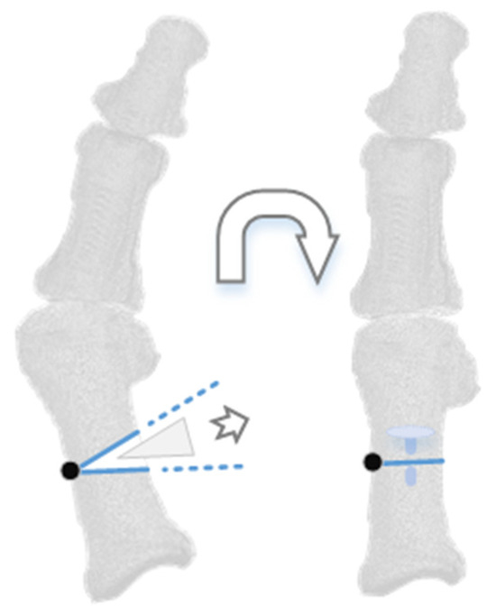 A Systematic Review of Osteotomies to Correct Hallux Valgus in the ...