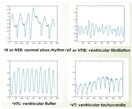 Prediction and Detection of Ventricular Fibrillation Using Complex ...