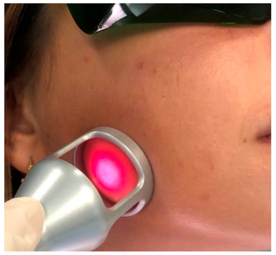 Impact of Single-Session Intraoral and Extraoral Photobiomodulation on ...