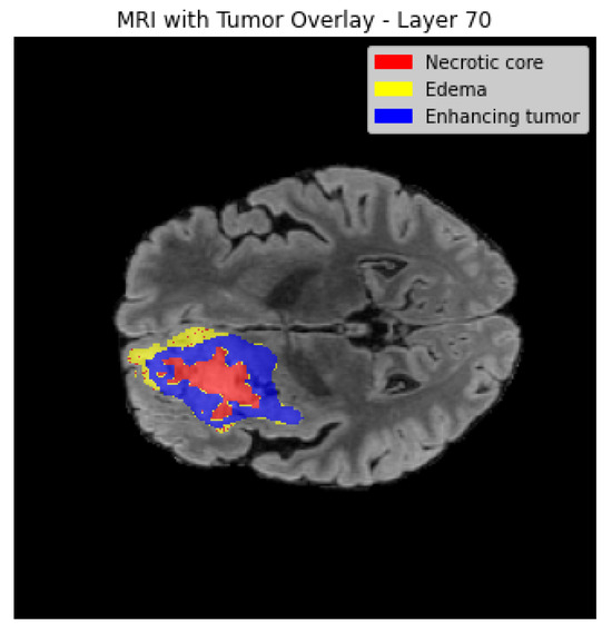 Advancing Brain Tumor Segmentation with Spectral–Spatial Graph Neural ...
