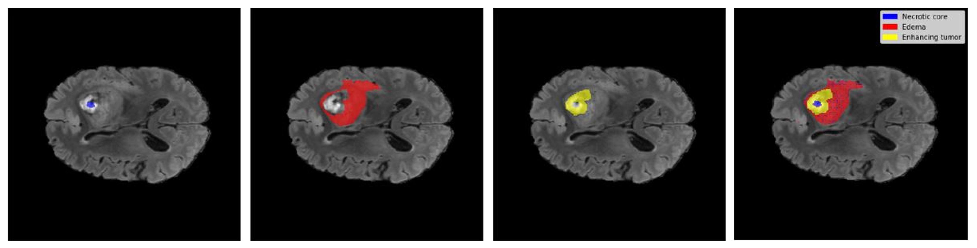 Advancing Brain Tumor Segmentation with Spectral–Spatial Graph Neural ...