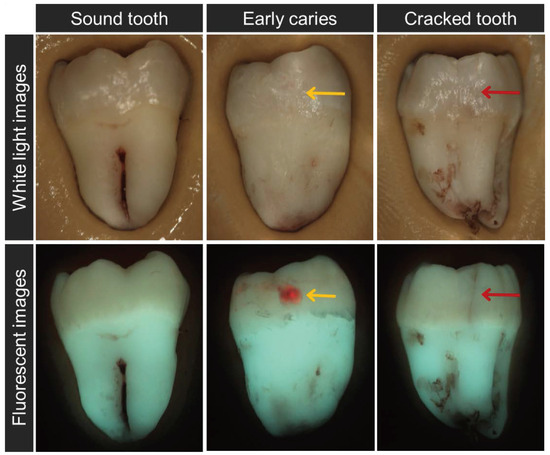 Effect of Rubber Cup Rotational Speeds during Tooth Polishing on Sound ...